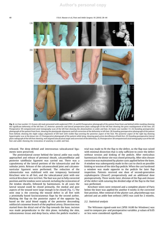 Complete subtalar release for older children with neglected CTEV ...