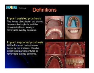 13.edent max overlay dentures | PDF