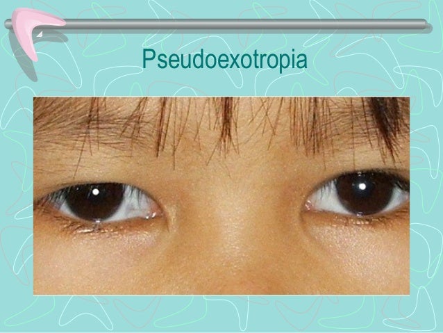 13 exotropia