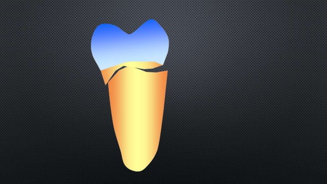 13- failures in fixed prosthesis.pptx sunumu için gerekli | PPT