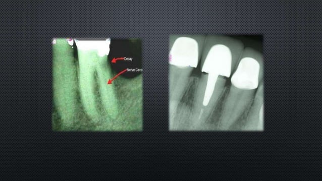 13- failures in fixed prosthesis.pptx sunumu için gerekli | PPT
