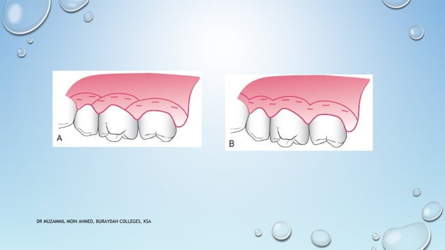 GINGIVECTOMY AND GINGIVOPLASTY | PPT | Dental Health | Diseases and ...