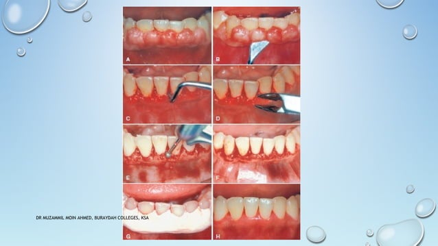 GINGIVECTOMY AND GINGIVOPLASTY