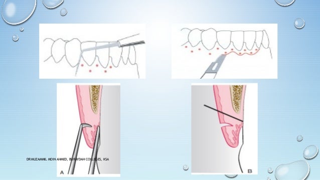GINGIVECTOMY AND GINGIVOPLASTY