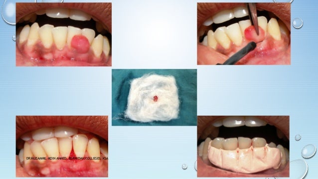 GINGIVECTOMY AND GINGIVOPLASTY