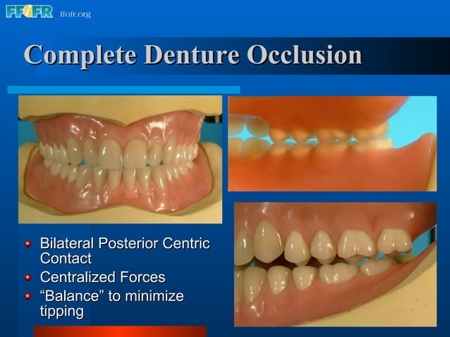 13.natural vs. complete centure occlusion | PPT