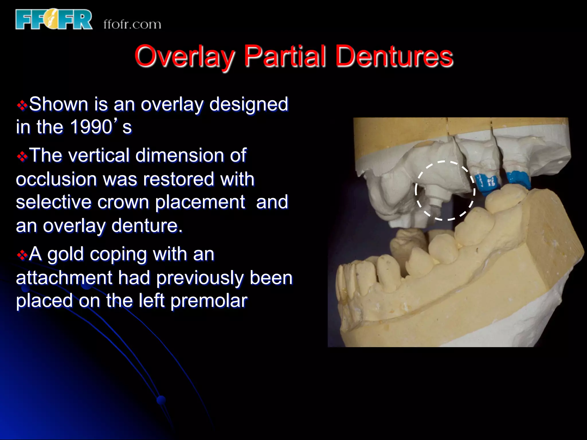 13.overlay rpd’s | PDF