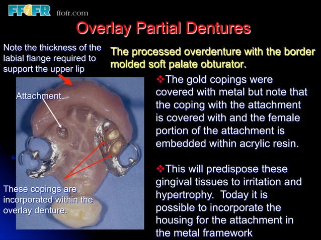 13.overlay rpd’s | PDF | Dental Health | Diseases and Conditions