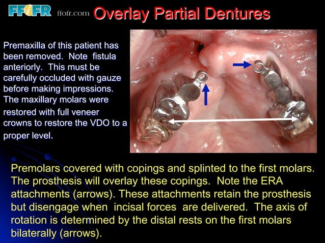 13.overlay rpd’s | PDF | Dental Health | Diseases and Conditions