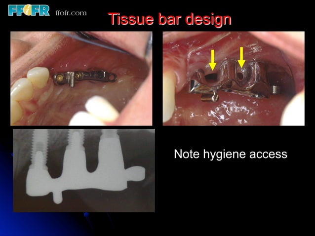 13.overlay rpd’s | PDF | Dental Health | Diseases and Conditions