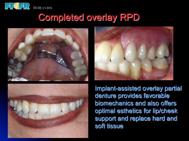 13.overlay rpd’s | PDF | Dental Health | Diseases and Conditions