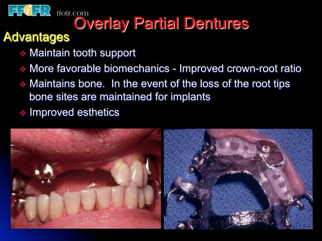 13.overlay rpd’s | PDF | Dental Health | Diseases and Conditions