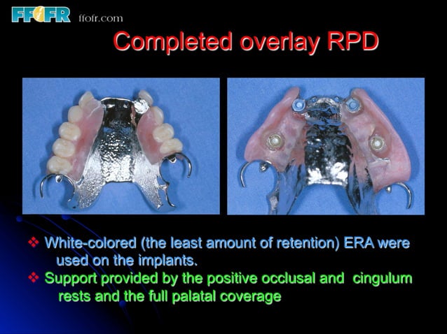 13.overlay rpd’s | PDF | Dental Health | Diseases and Conditions