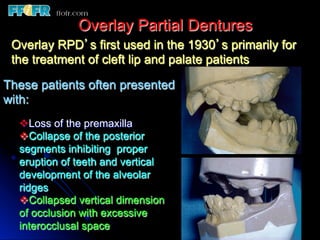 13.overlay rpd’s | PDF