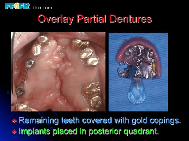 13.overlay rpd’s | PDF | Dental Health | Diseases and Conditions