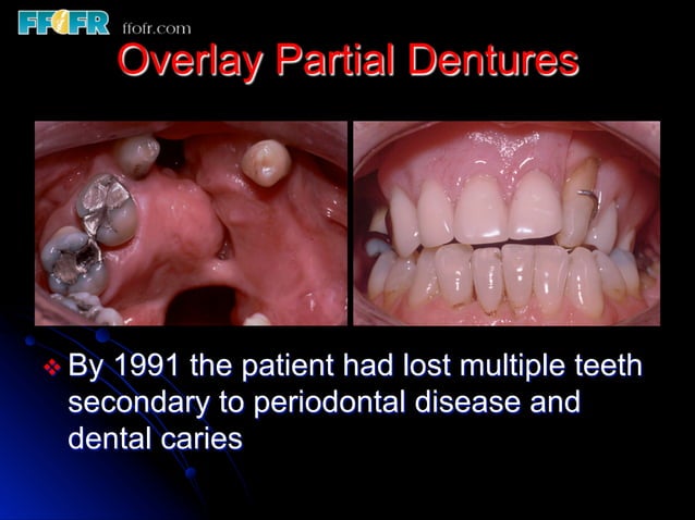 13.overlay rpd’s | PDF | Dental Health | Diseases and Conditions