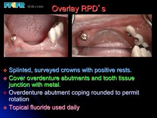 13.overlay rpd’s | PPT