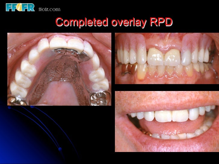 13.overlay rpd’s