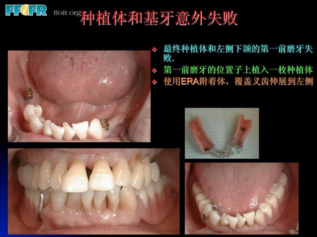 13.overlay rpd’s | PPT