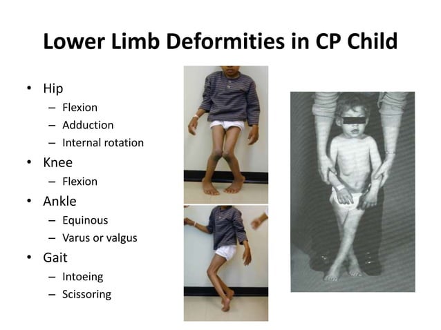 13-pediatric common lower limb disorders (1).ppt