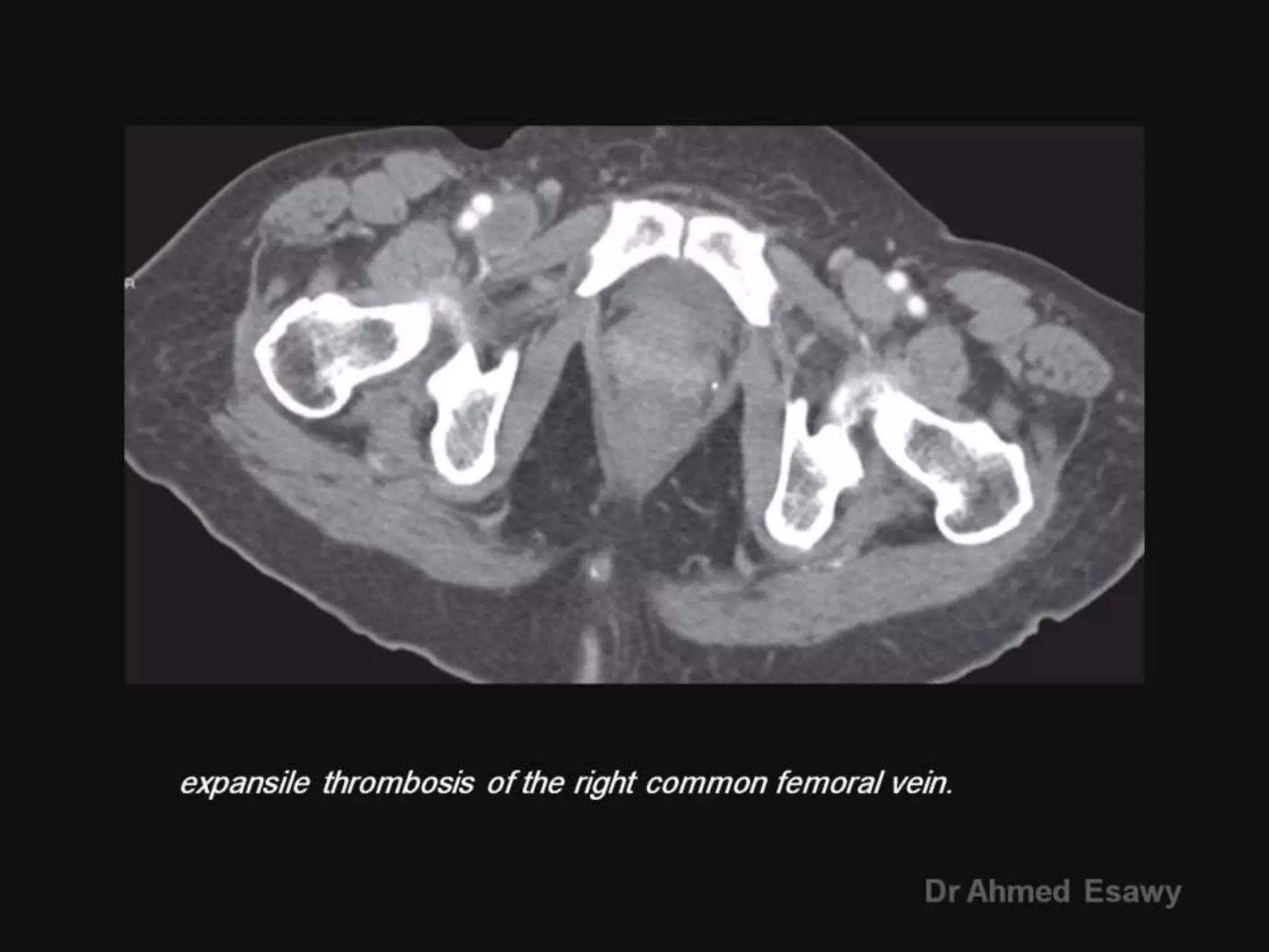13 peripheral venous duplex ct mri in dvt dr ahmed esawy | PPTX