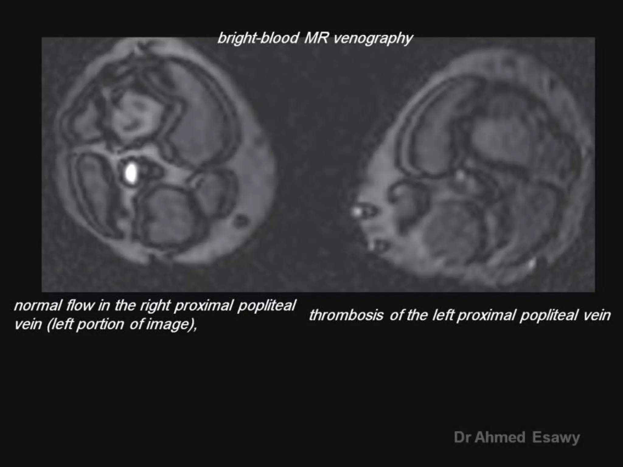 13 peripheral venous duplex ct mri in dvt dr ahmed esawy | PPT