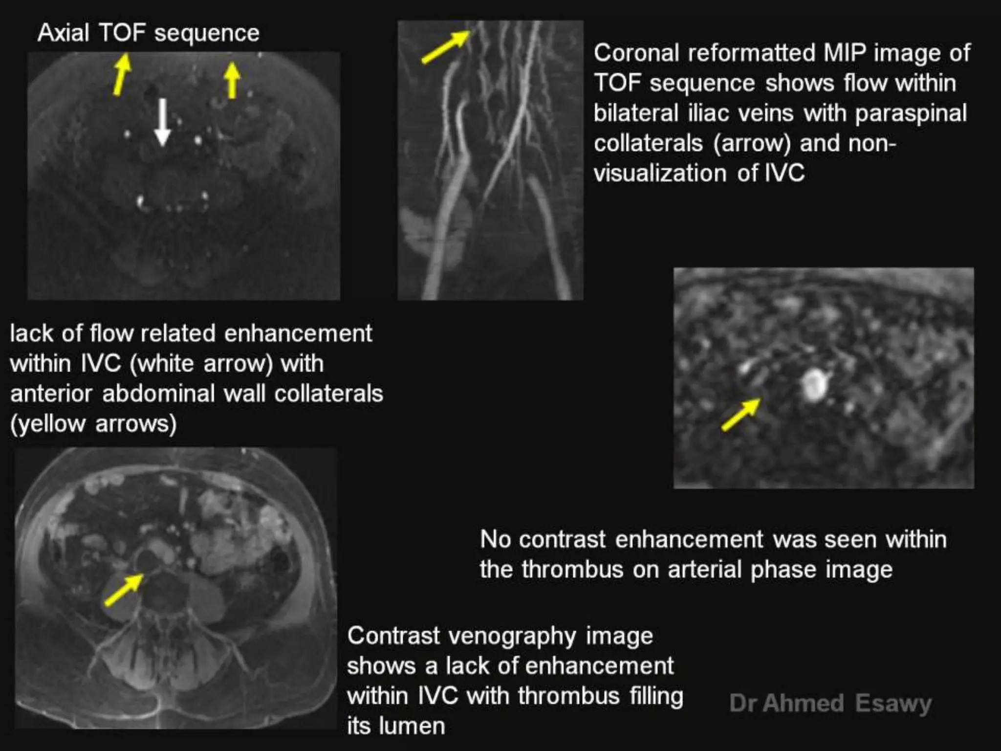 13 peripheral venous duplex ct mri in dvt dr ahmed esawy | PPTX