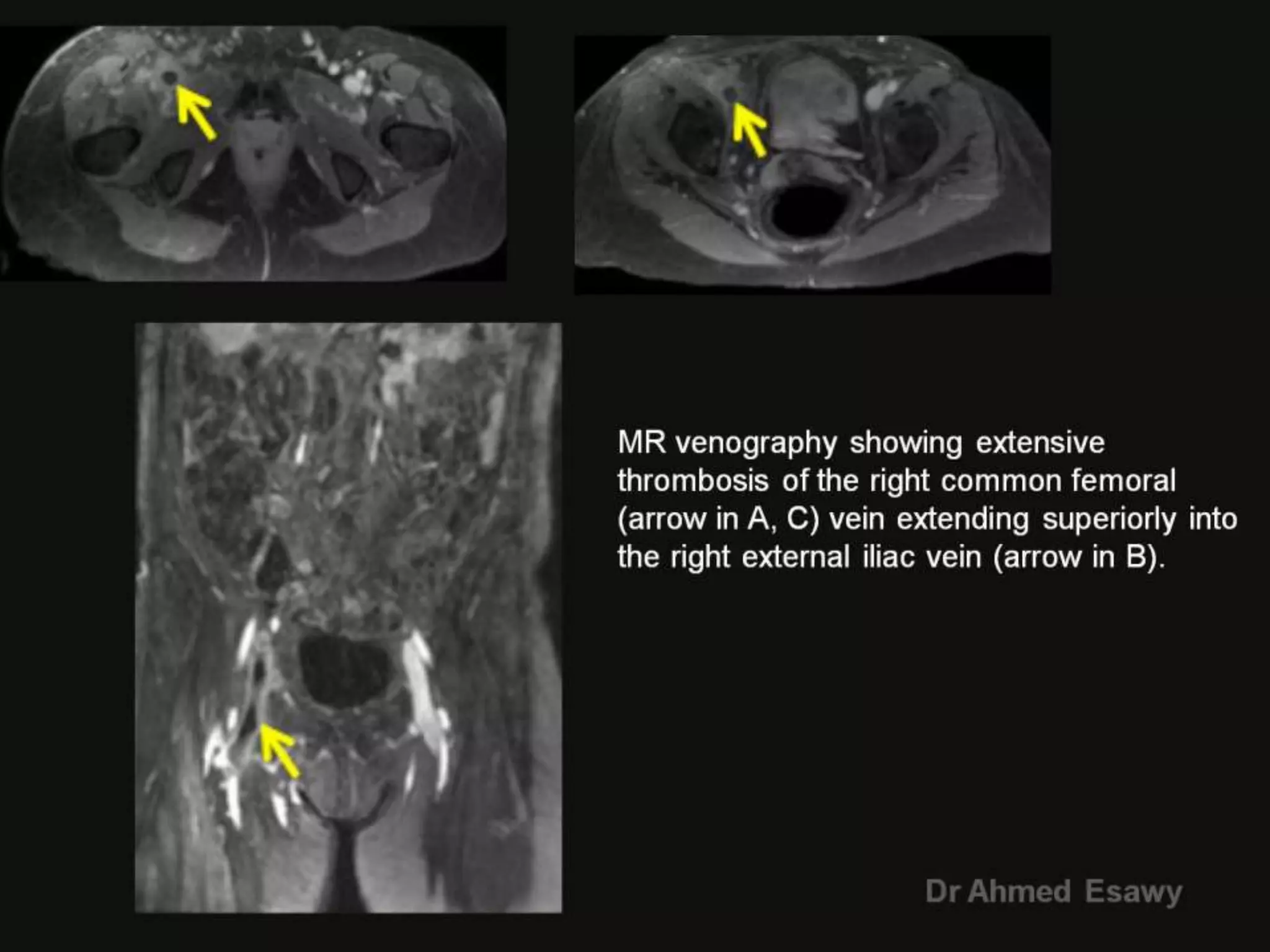 13 peripheral venous duplex ct mri in dvt dr ahmed esawy | PPTX
