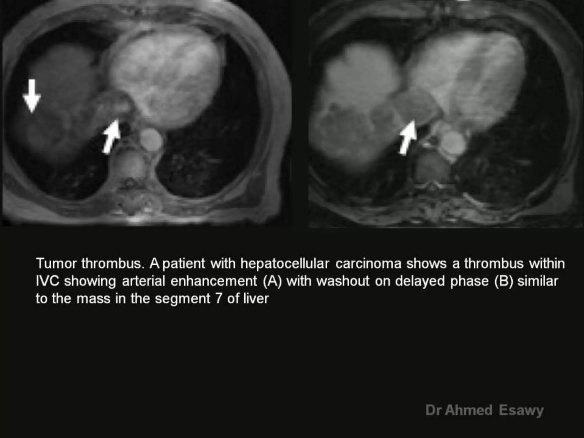 13 peripheral venous duplex ct mri in dvt dr ahmed esawy | PPTX