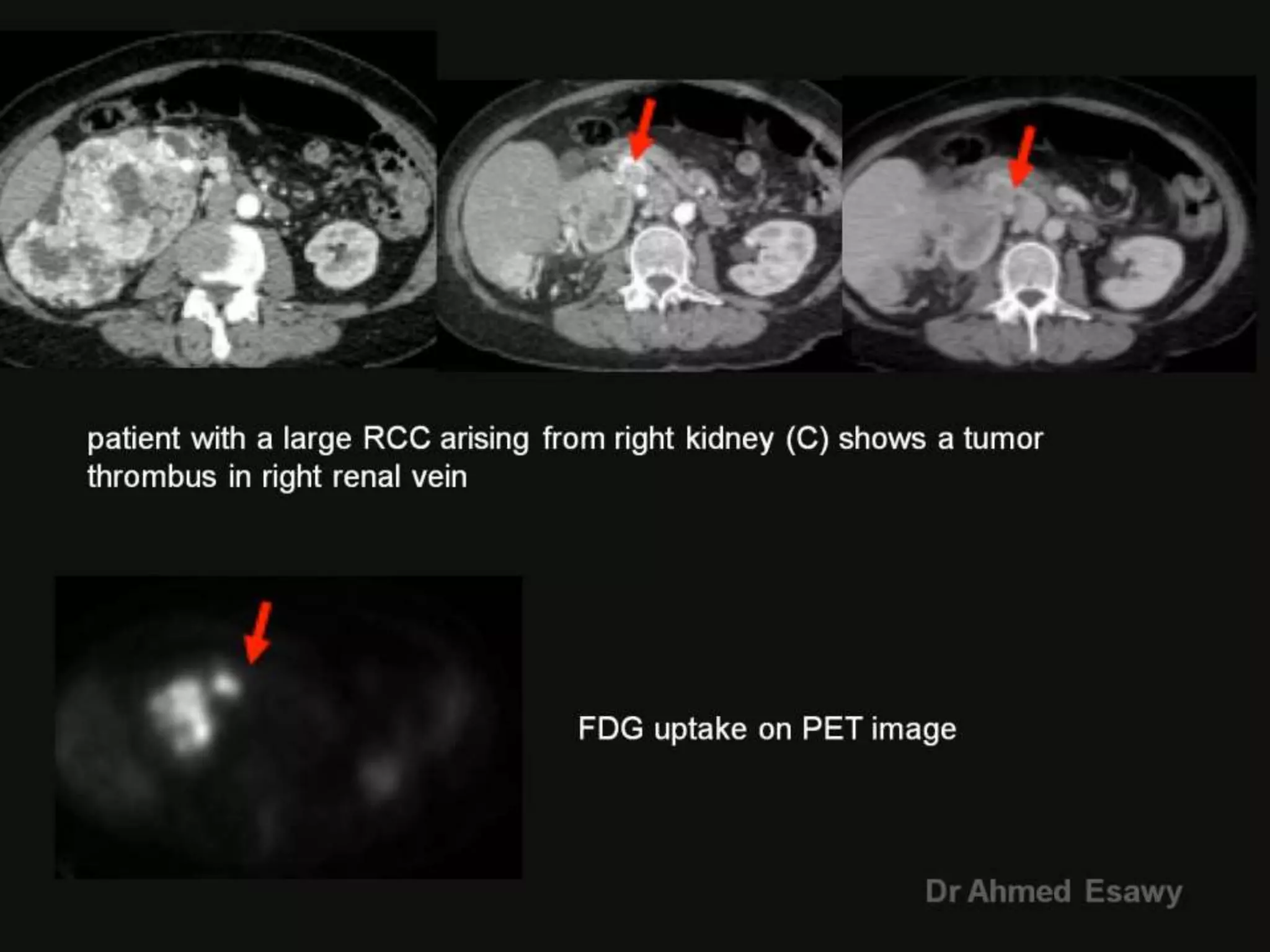 13 peripheral venous duplex ct mri in dvt dr ahmed esawy | PPTX