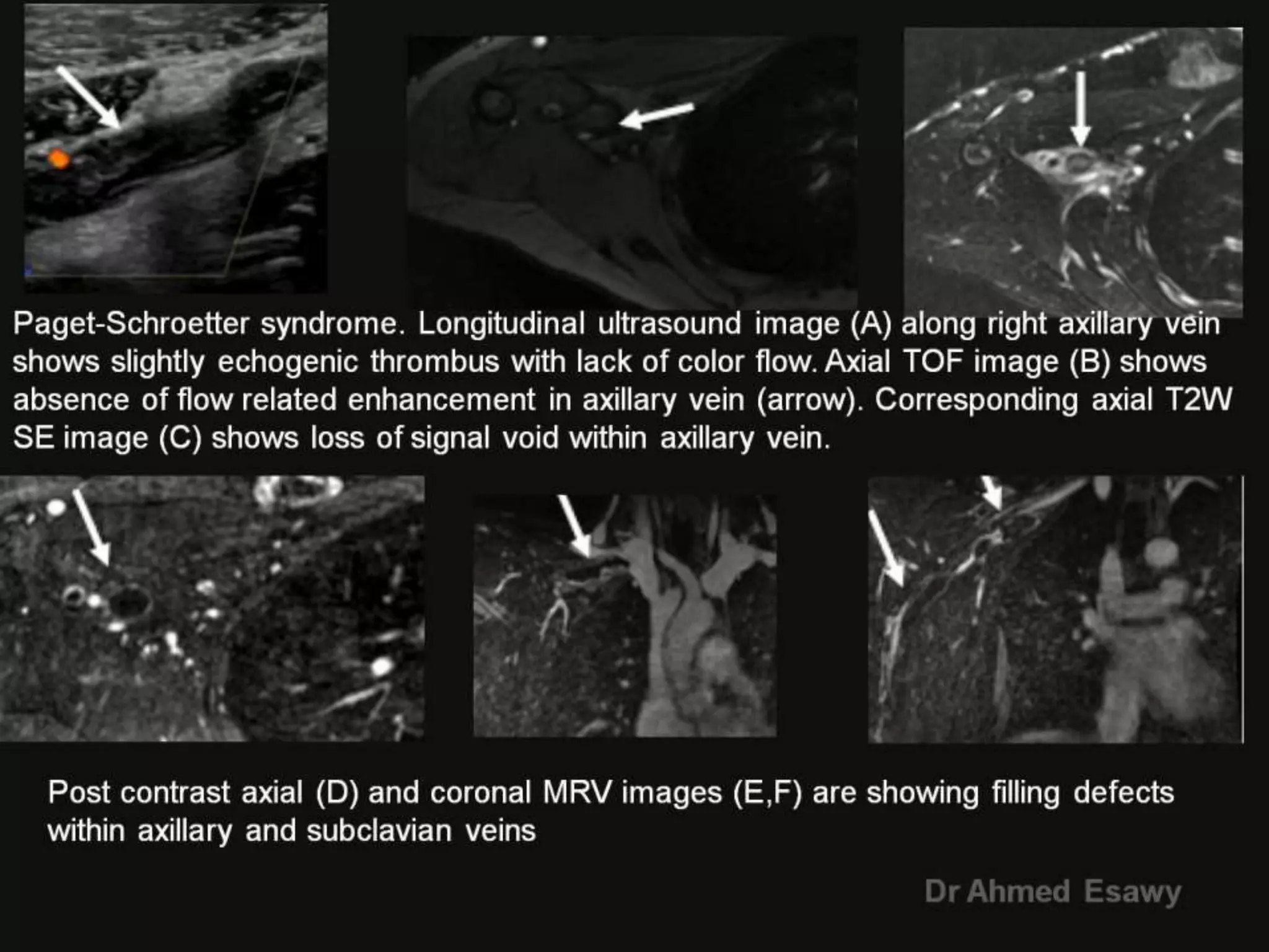 13 peripheral venous duplex ct mri in dvt dr ahmed esawy | PPTX