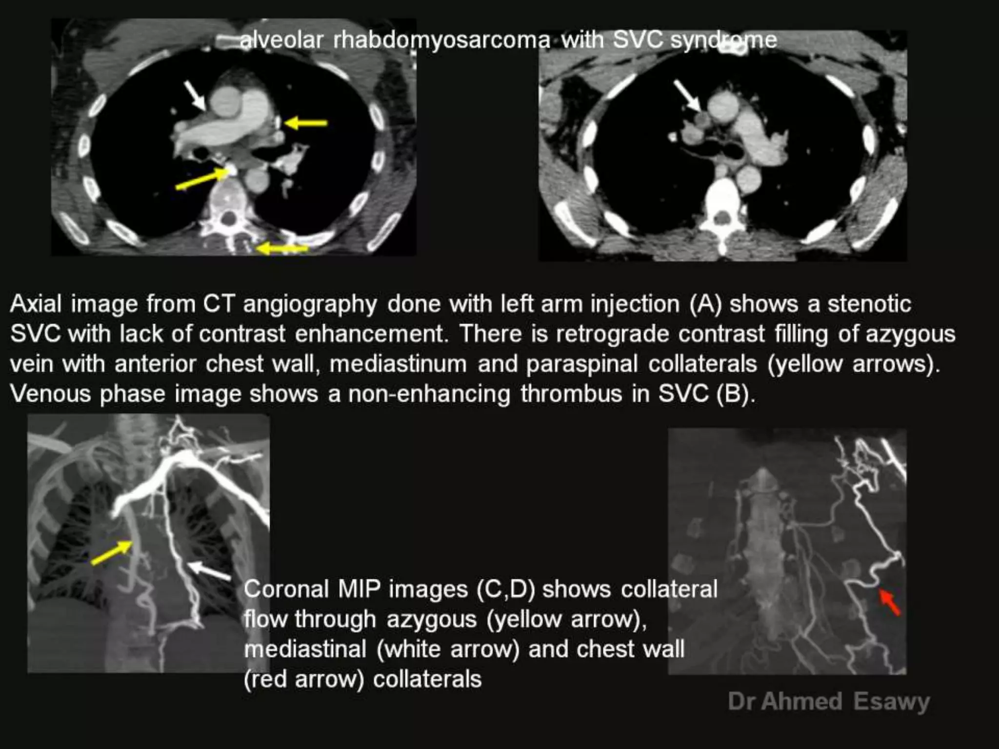 13 peripheral venous duplex ct mri in dvt dr ahmed esawy | PPT