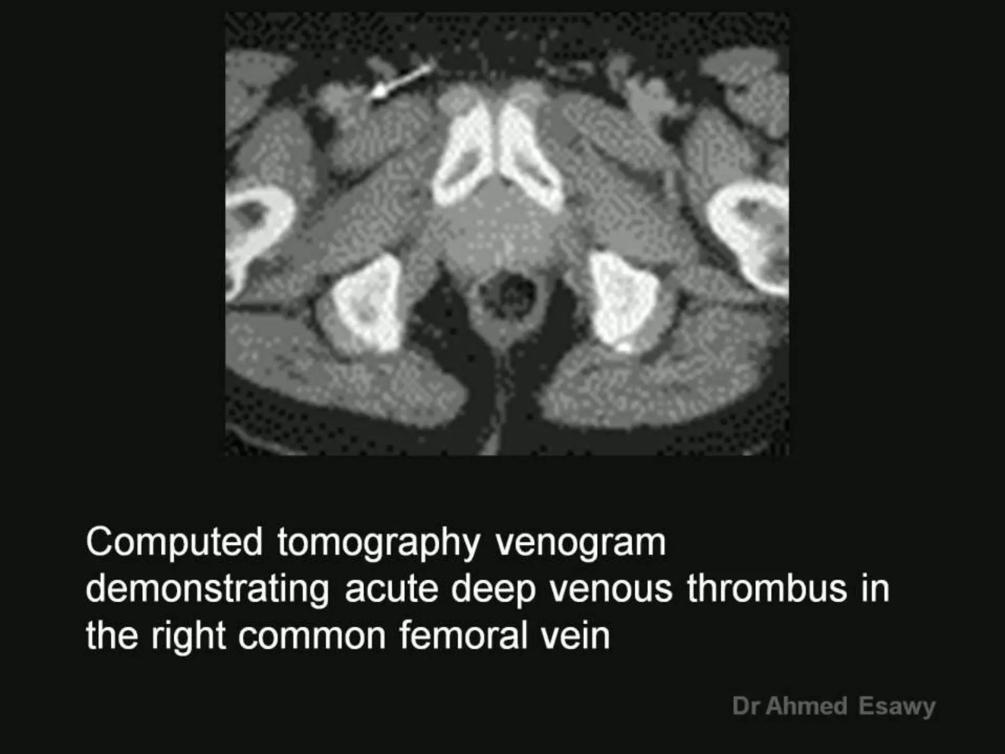 13 peripheral venous duplex ct mri in dvt dr ahmed esawy | PPTX