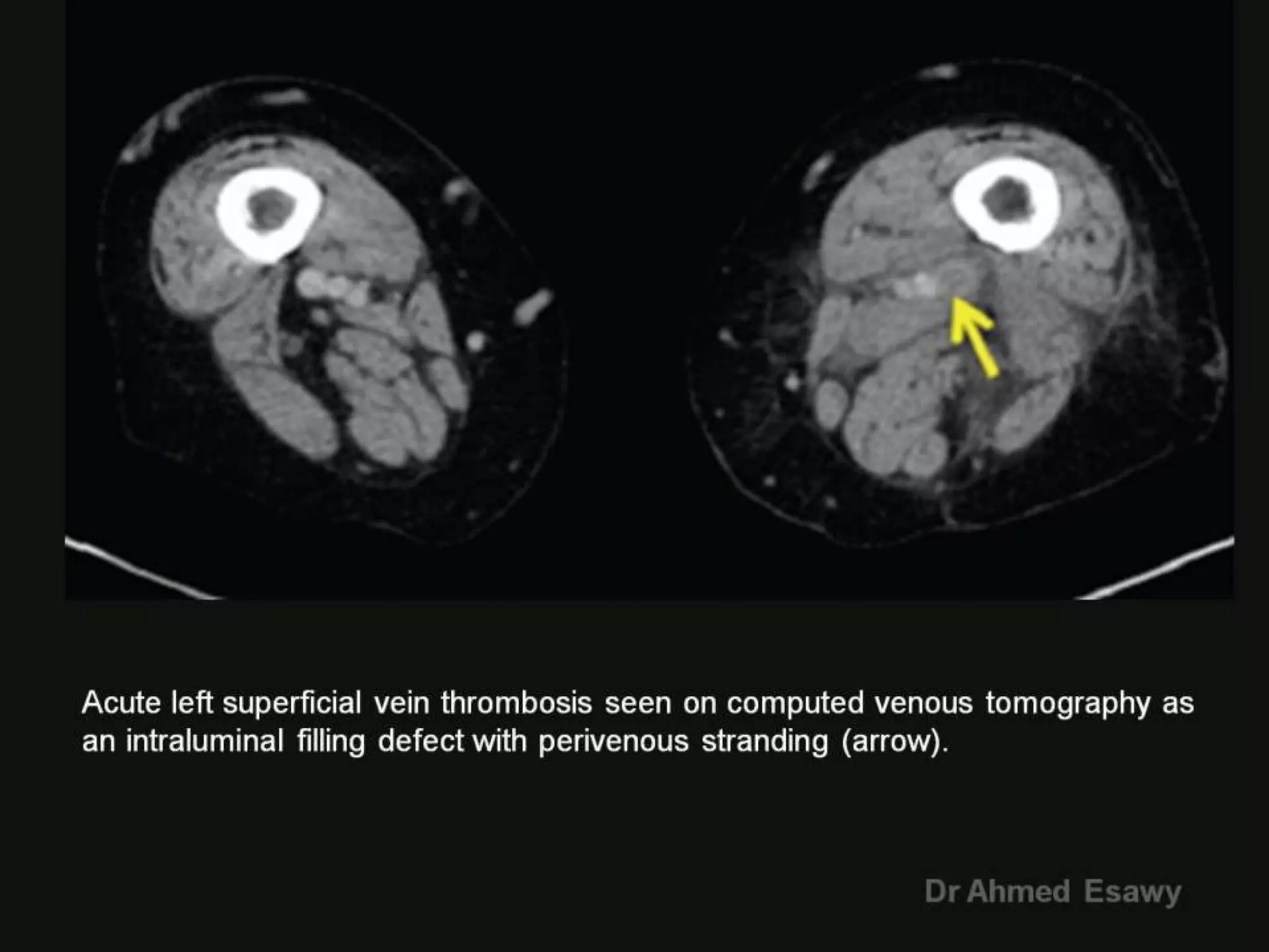 13 peripheral venous duplex ct mri in dvt dr ahmed esawy | PPT