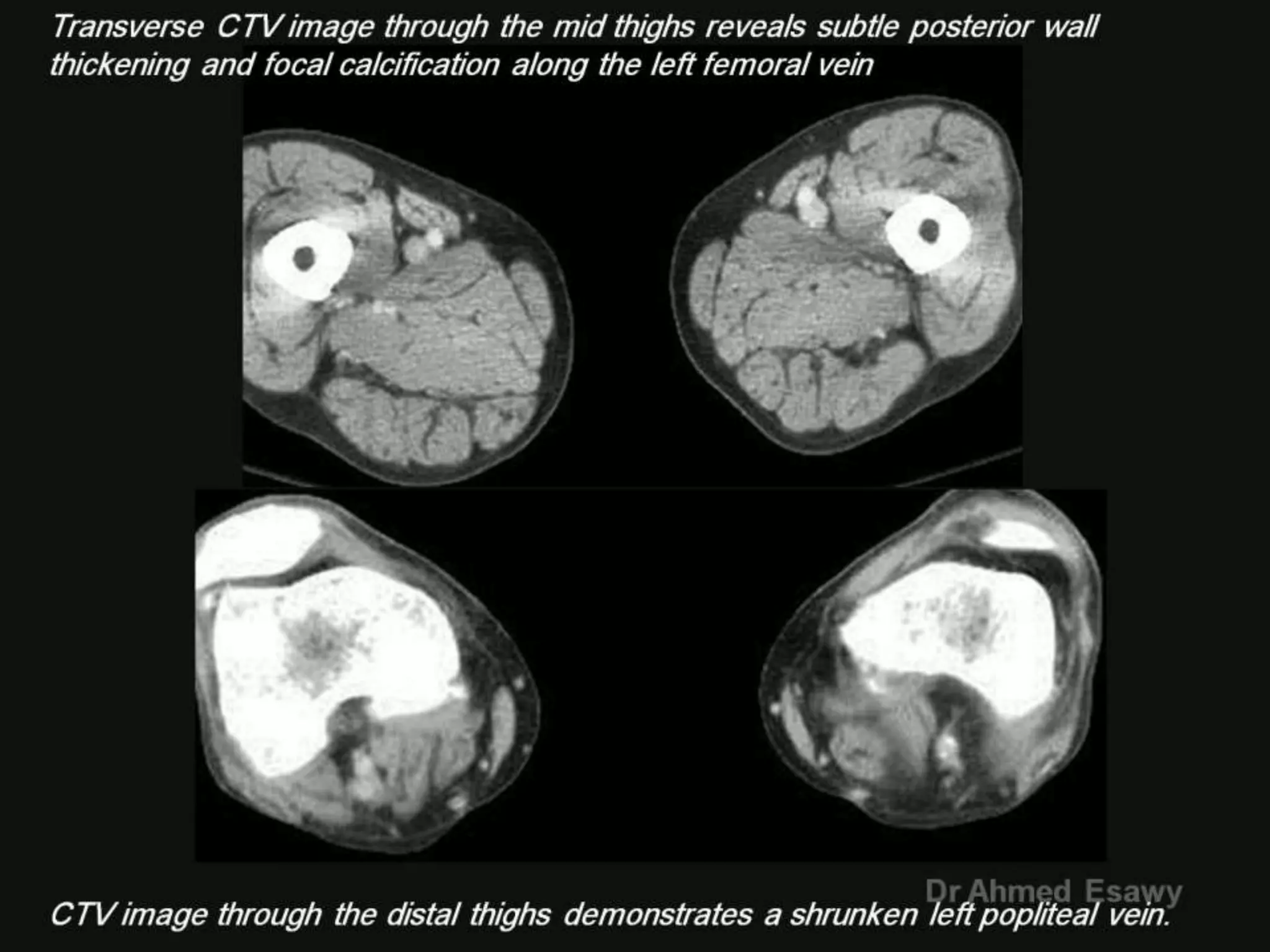 13 peripheral venous duplex ct mri in dvt dr ahmed esawy | PPTX
