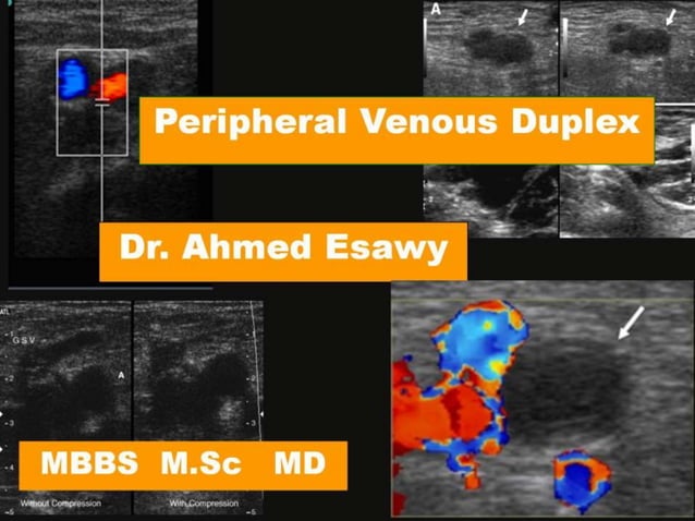 13 peripheral venous duplex ct mri in dvt dr ahmed esawy | PPT