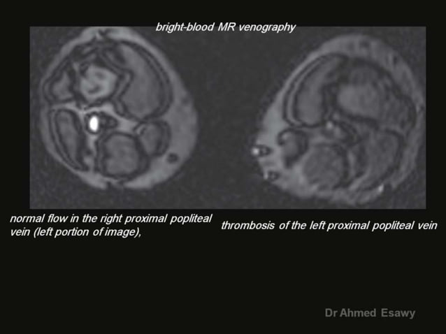 13 peripheral venous duplex ct mri in dvt dr ahmed esawy | PPT