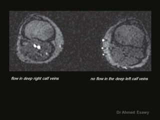13 peripheral venous duplex ct mri in dvt dr ahmed esawy | PPT