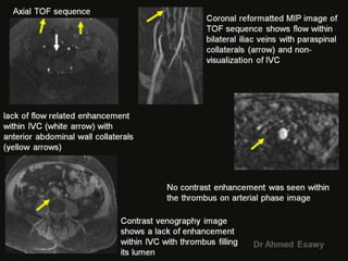 Dvt Ct プロトコル – Ct Venography 下肢静脈血栓症 – GTDPN