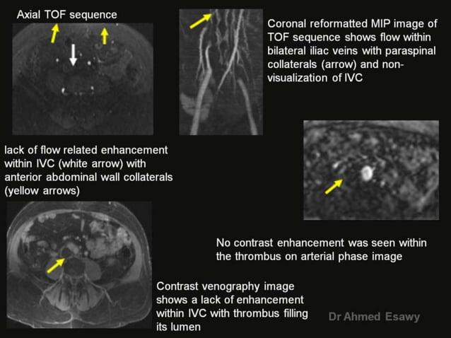 13 peripheral venous duplex ct mri in dvt dr ahmed esawy | PPT