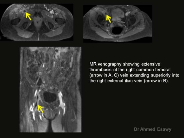 13 peripheral venous duplex ct mri in dvt dr ahmed esawy | PPT