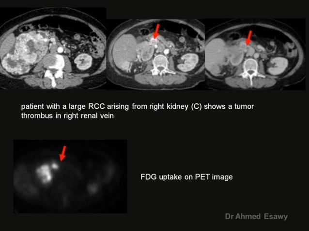 13 peripheral venous duplex ct mri in dvt dr ahmed esawy | PPT