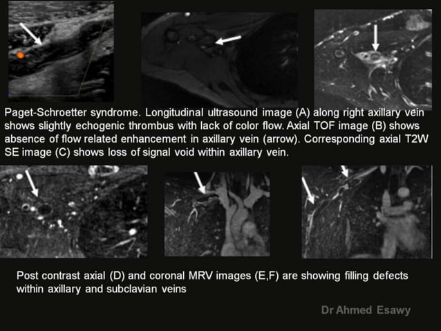 13 peripheral venous duplex ct mri in dvt dr ahmed esawy | PPT