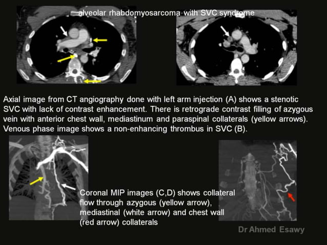 13 peripheral venous duplex ct mri in dvt dr ahmed esawy | PPT