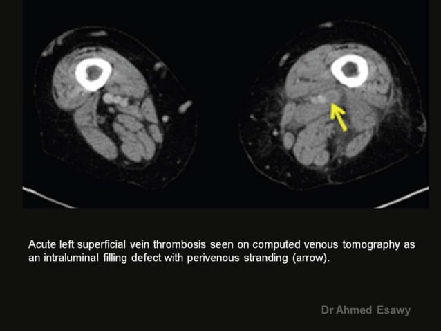 13 peripheral venous duplex ct mri in dvt dr ahmed esawy | PPT