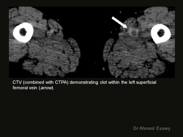 13 peripheral venous duplex ct mri in dvt dr ahmed esawy | PPT