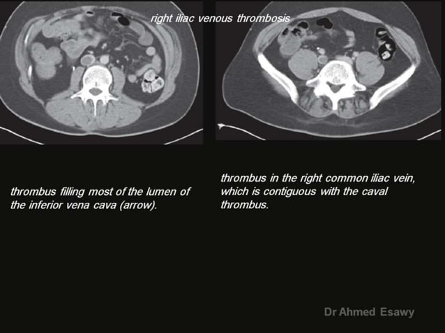 13 peripheral venous duplex ct mri in dvt dr ahmed esawy | PPT
