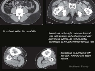 13 peripheral venous duplex ct mri in dvt dr ahmed esawy | PPT