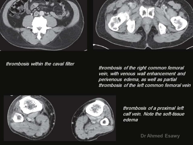 13 peripheral venous duplex ct mri in dvt dr ahmed esawy | PPT