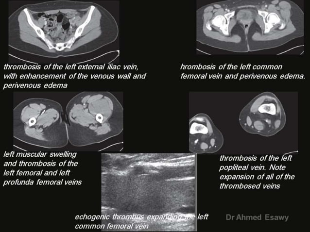 13 peripheral venous duplex ct mri in dvt dr ahmed esawy | PPT